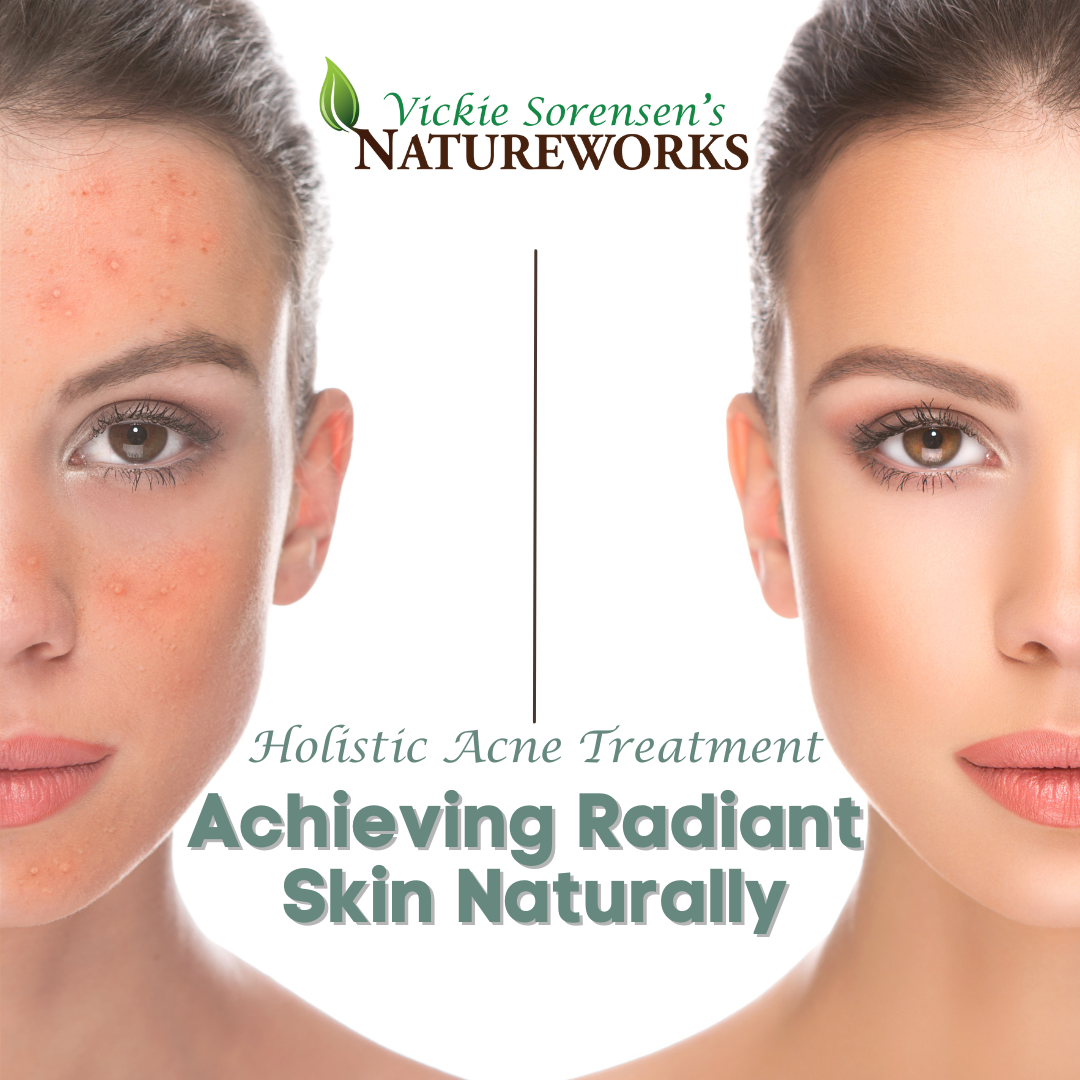 Achieving Radiant Skin Naturally: Holistic Acne Treatment – Vickie ...